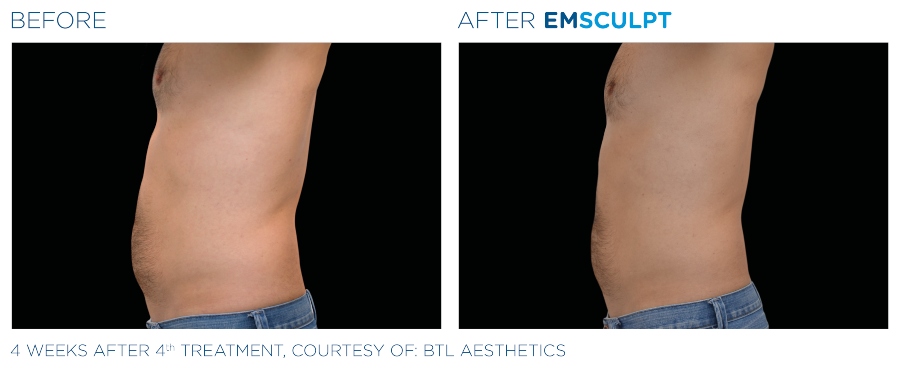 EMSCULPT Treatment Before & After Images | Suite Six Medical Aesthetics