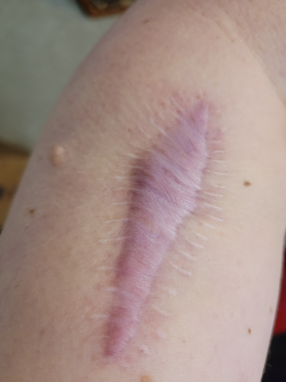 Keloid Scar Treatments in Newburyport | Suite Six Medical Aesthetics